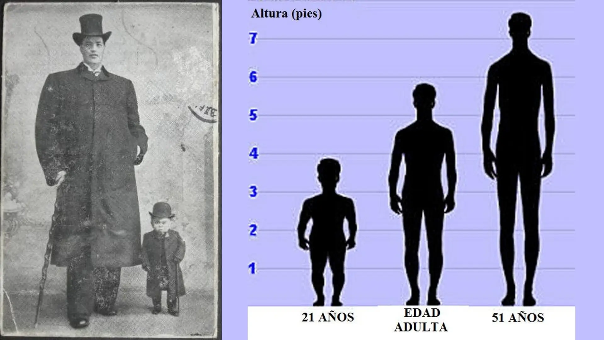 Adam Rainer, el único ser humano que ha padecido enanismo y gigantismo