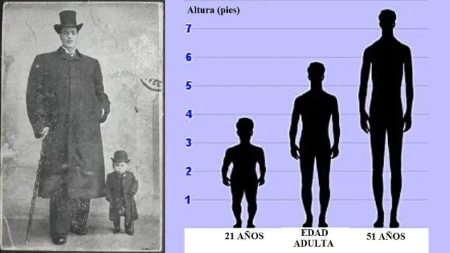 Adam Rainer, el único ser humano que ha padecido enanismo y gigantismo